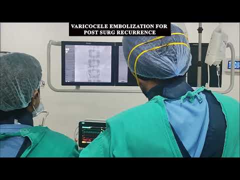 Varicocele Embolization for Post Surg Recurrence | #irfacilities #doctor #interventionalradiology