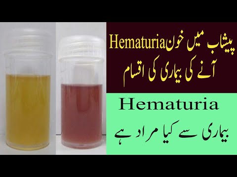 Gross And Microscopic Hematuria Type Blood In Urine In Urdu Peshab Mein Khoon Aane Ki 2 Iqsam