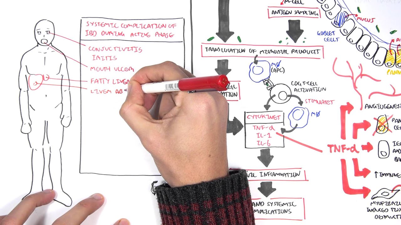 Inflammatory Bowel Disease - Pathophysiology and Complications
