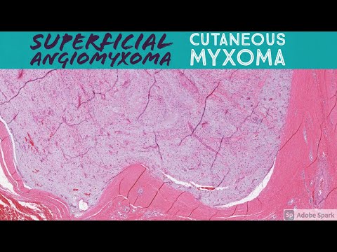 Cutaneous Myxoma (aka Superficial Angiomyxoma)