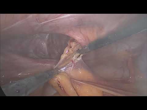 Laparoscopic IPOM Plus for Post C-Section Pfannenstiel Incisional Hernia by Dr Vishal Soni