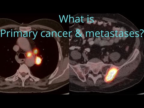प्राइमरी केंसर और मेटास्टेसिस क्या होता है? What is Primary cancer & metastases? #fdg #petct #cancer