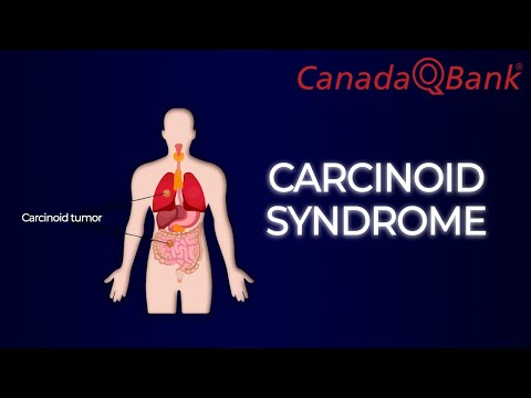 Carcinoid Syndrome