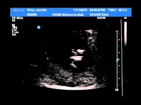 Baby Sims No 2 - 12 week scan
