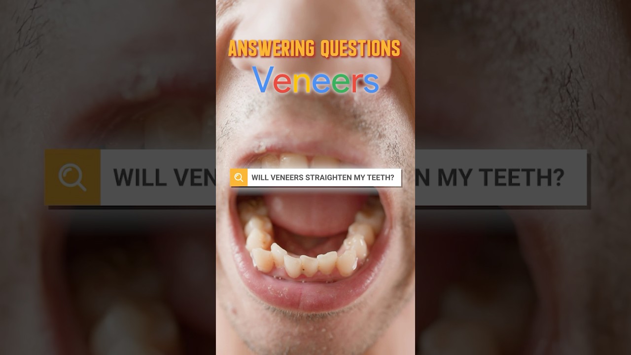 🔴  Will Veneers Straighten My Crooked Teeth?🤔 Dentist Explains! #shorts #veneers #dentist