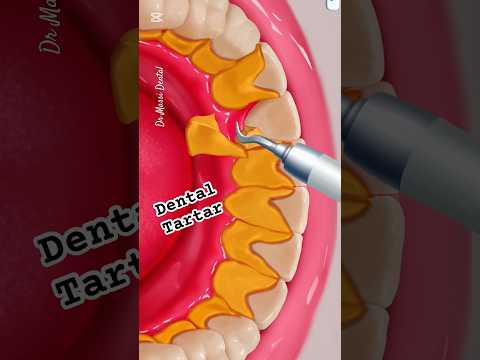DENTAL TARTAR
