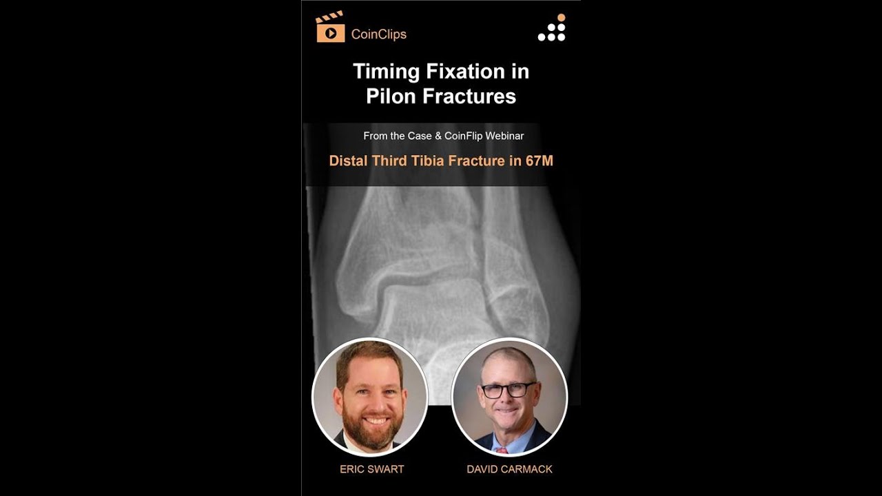 Timing Fixation in Pilon Fractures