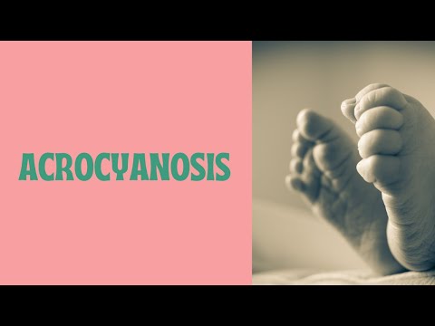 Acrocyanosis