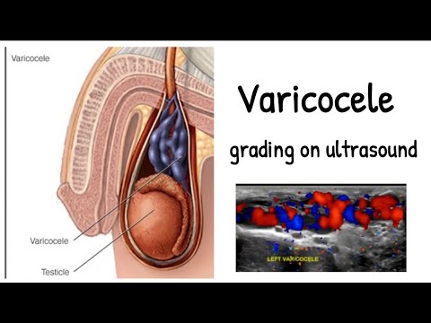 varicocele and its ultrasound grading