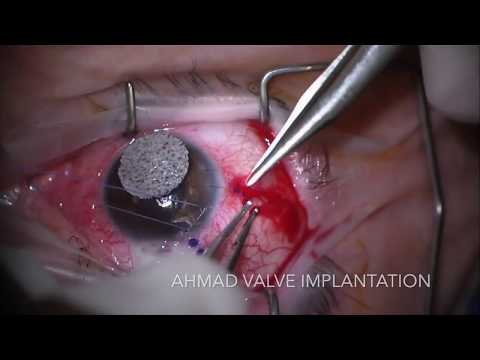 أفضل مركز لطب العيون بالسعودية eye surgeries in Saudi Arabia 🇸🇦