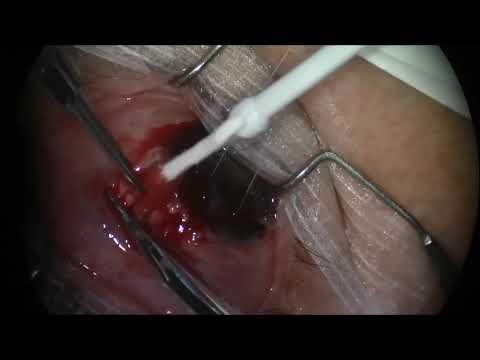 Overhanging Bleb Revision