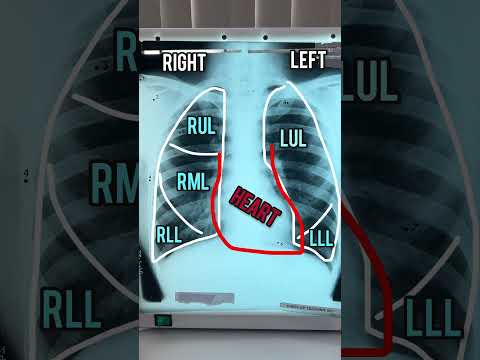 BEST WAY TO READ CHEST X-RAY