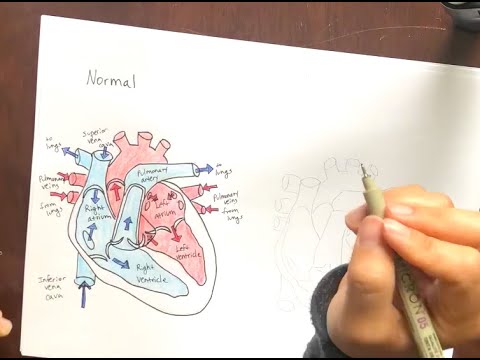 Tetralogy of Fallot