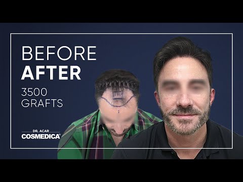 Hair Transplant in Turkey | Hair Transplant Results of Cosmedica