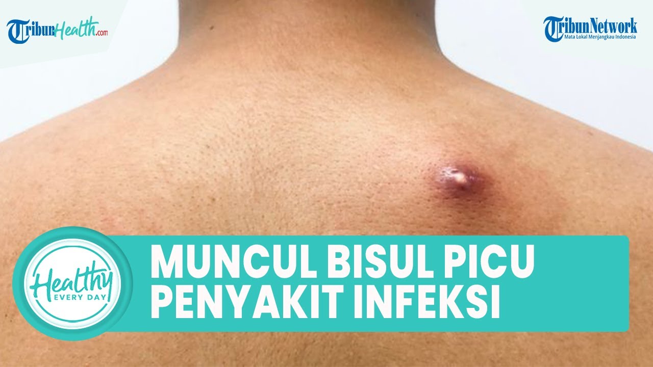 Waspadai Munculnya Bisul pada Tubuh Dapat Picu Infeksi, Begini Cara ...