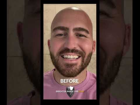 Real Client Review - W/ Cosmetic Incredibil™ Veneers