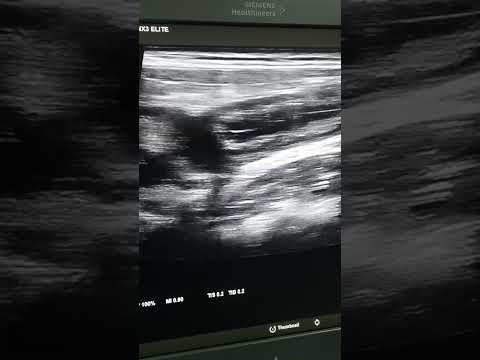 APPENDICITIS, ULTRASOUND FEATURES OF INFLAMMED APPENDIX