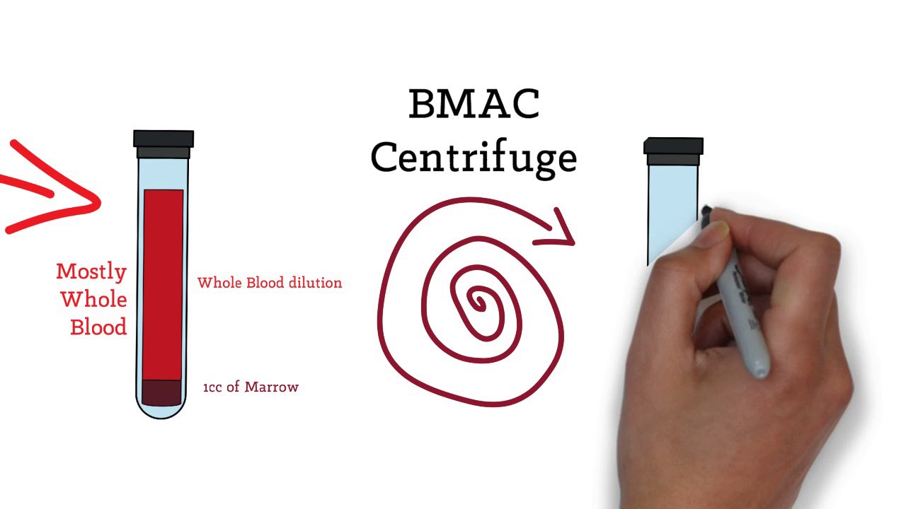 Marrow Cellution vs BMAC