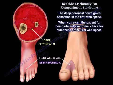 Bedside Fasciotomy for Compartment Syndrome - Indications and Technique • Video • MEDtube.net