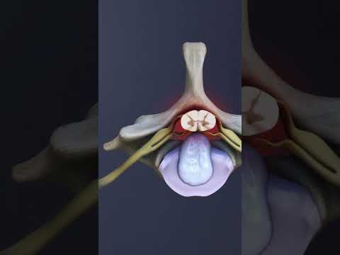 Compression of the Spinal Cord at the C6-C7 Spinal Level