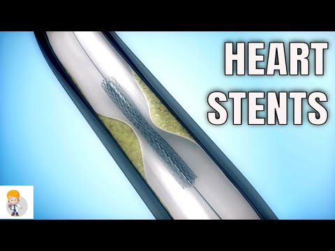 Drug-eluting stents (DES) Vs. Bare metal stents (BMS)