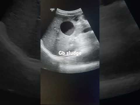 Gall bladder sludge ultrasonigraphy sonography #ultrasound #radiology