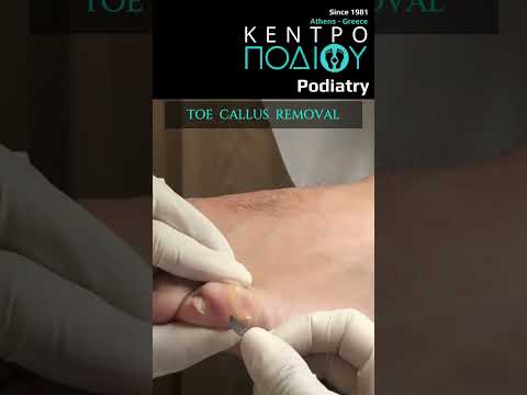 Toe Callus removal|Αφαίρεση επιδακτύλιου κάλου|Κέντρο Ποδιού Podiatry|Podiatrist|Ποδιατρική|Ποδίατρο