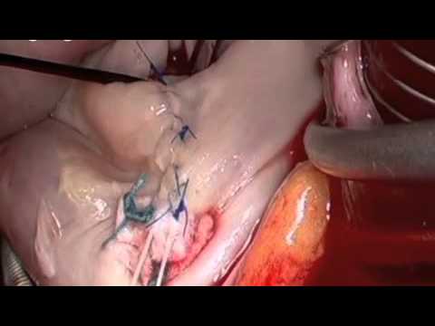 MVR video