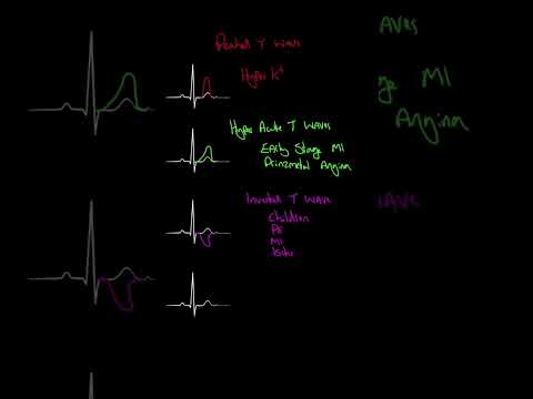 Abnormal T waves found in an ECG