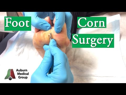 Foot Corn Surgery Treatment