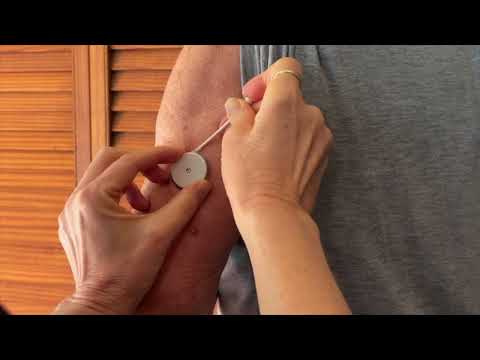 Continuous Glucose Monitoring (CGM) Device Removal with Detachol Adhesive Remover