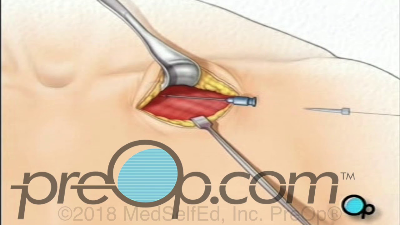 Permanent Pacemaker Implant Surgery - PreOp®  Patient Education