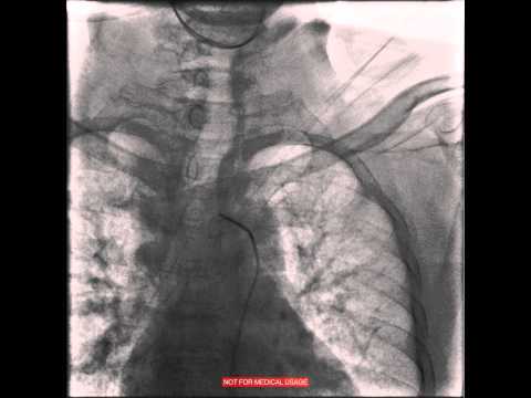 Left CCA Canulation - Advanced
