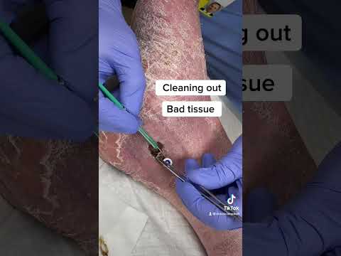 Debriding an ulcer after a severe infection | #shorts