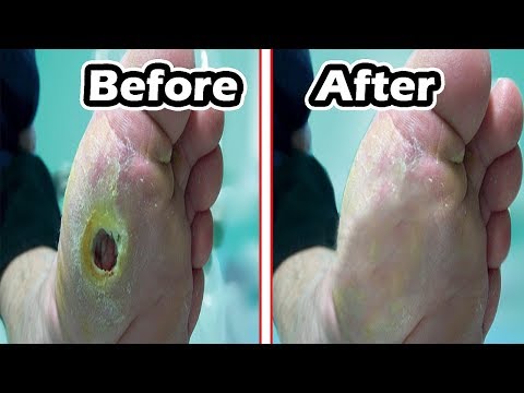 Remove Foot Calluses with Top 5 Home Remedies