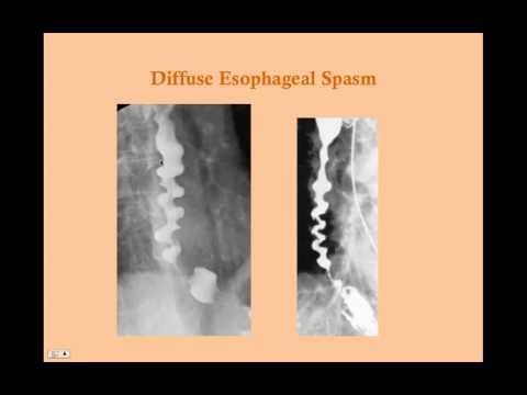 Esophageal Disorders (old version, with sound) - CRASH! Medical Review Series