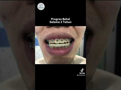 Satisfying banget liat progres behel sampe jadi rapi gini๐ #behelgigi #gigi #behel #bracesupdate