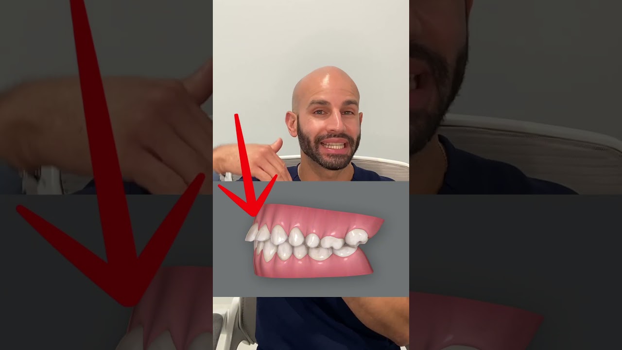 Overbite Correction with Invisalign: Our Smile Design Plan
