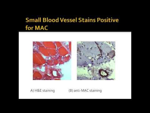 Lisa Christopher Stine - Statin Myopathy - When might it be autoimmune