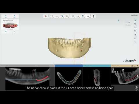 Defining the mandibular nerve in Implant Studio