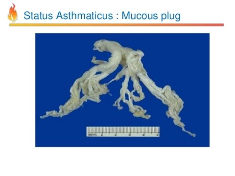 Status Asthmaticus 01202017