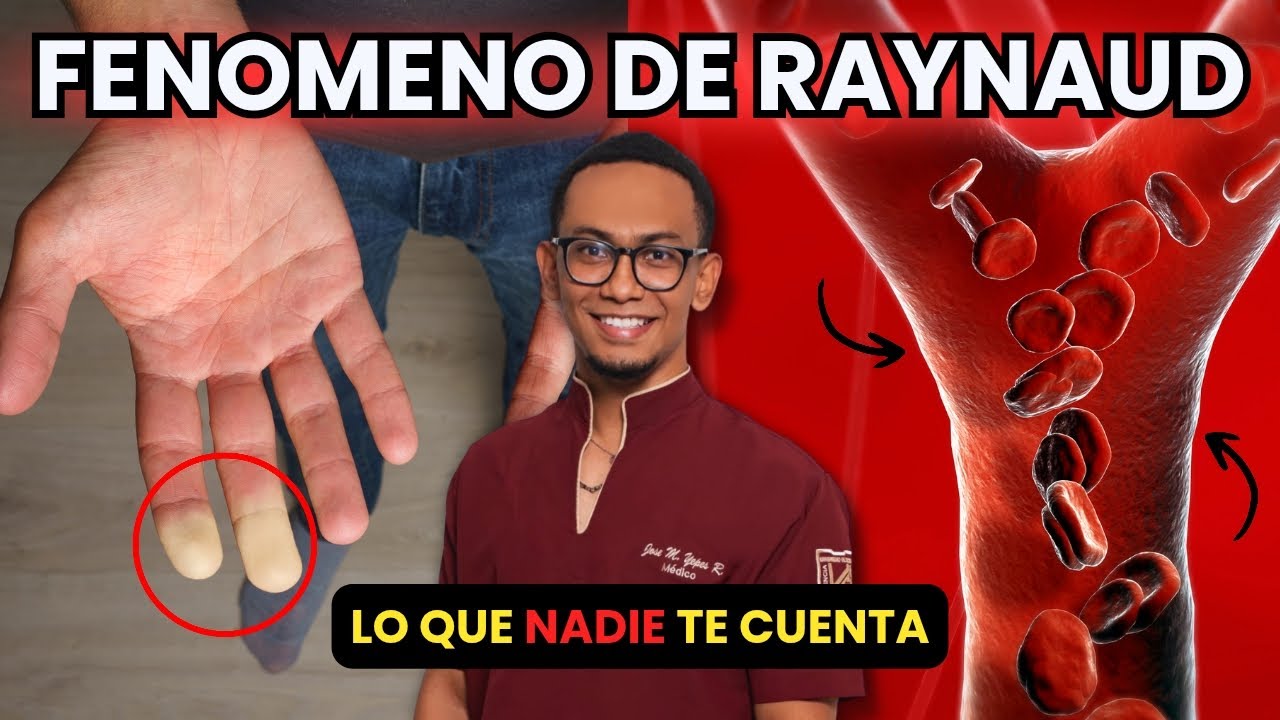 Raynaud's Phenomenon: What is it and how to treat it? I'll explain it to you in just 10 minutes!