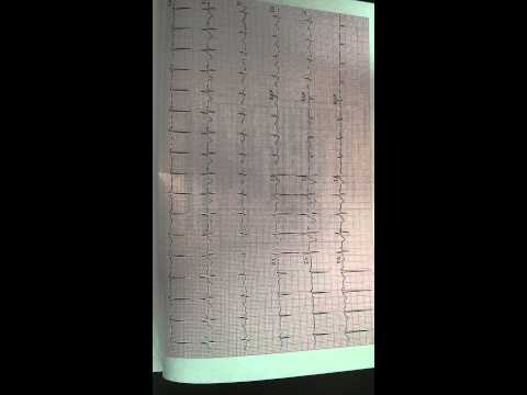 EKG ECG electrocardiogram Cardiologist Cardiology www.drbenzur.com