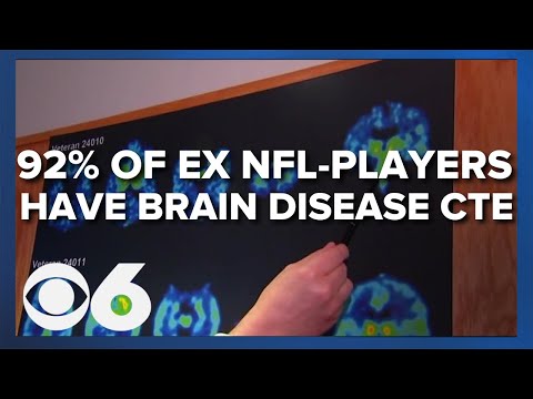 CTE found in nearly 92% of ex-NFL players studied