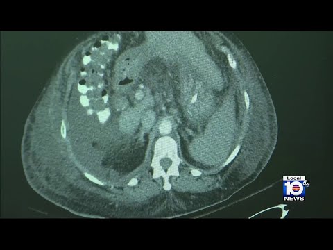 South Florida doctor discusses treatment for Cholangitis