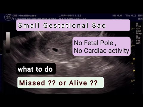 Ultrasound Early Pregnancy with Small Empty Gestational Sac , explained , what to do ??