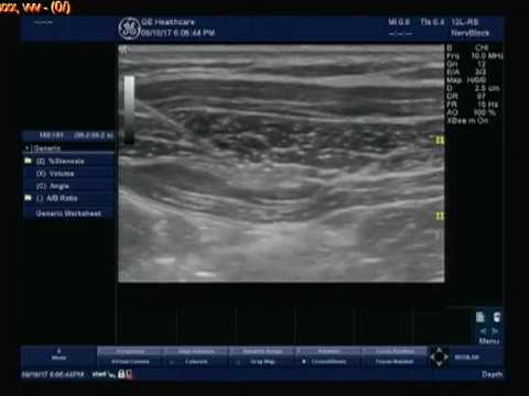 Deep Circumflex Iliac Artery in TAP Plane
