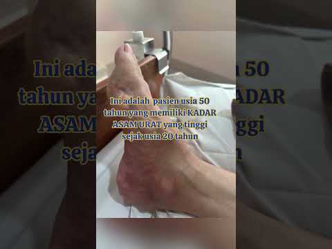 INI AKIBAT ASAM URAT TINGGI #nephrology #education #asamurat #shorts #kidneydisease