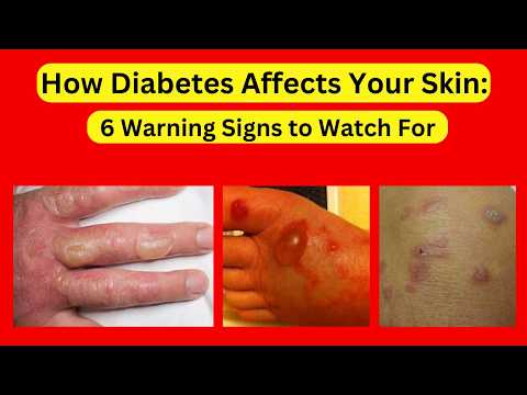 6 Hidden Skin Signs of Diabetes | Diabetes skin signs | Diabetes symptoms | ZeroDiabetes Zone
