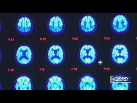 The FAST way to deal with a stroke patient
